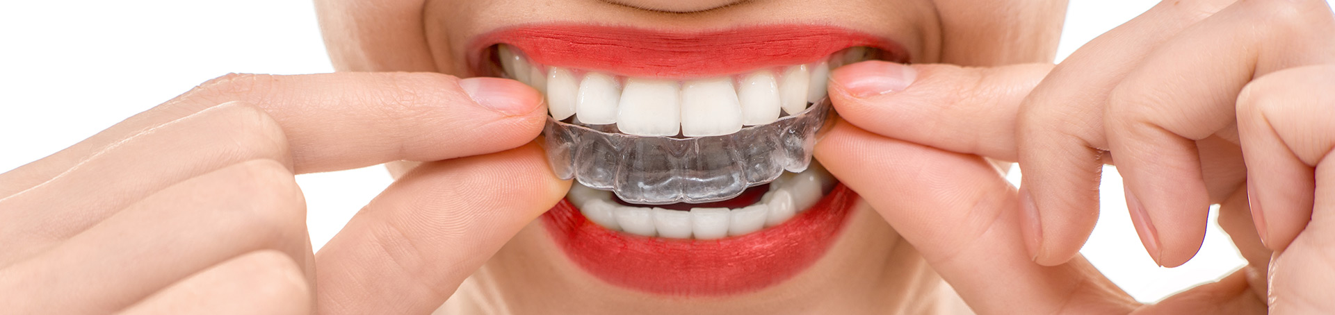 Clear Aligners Point Cook | Iris Dental Melbourne